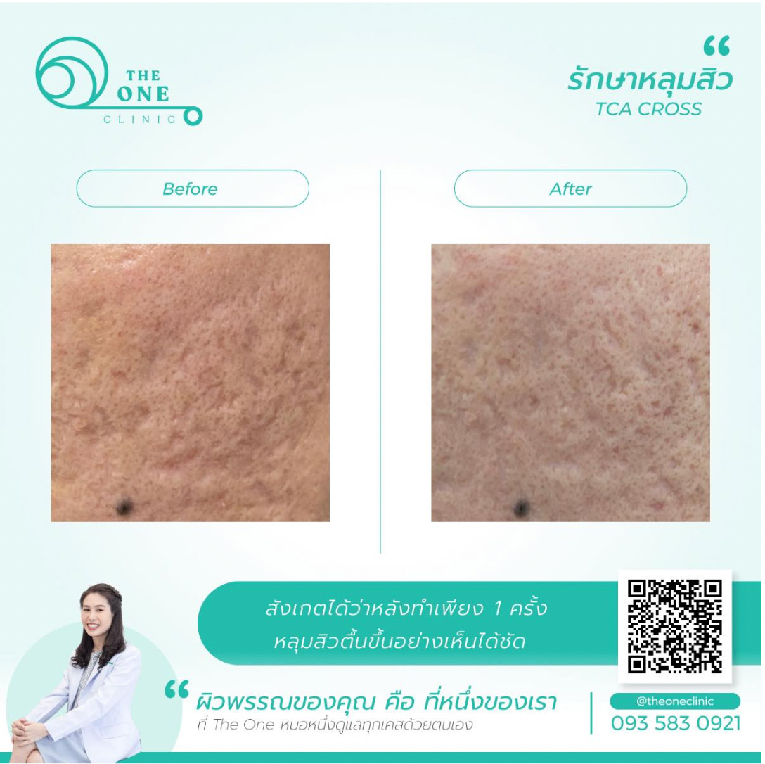 รักษาหลุมสิว TCA Cross | The One Clinic