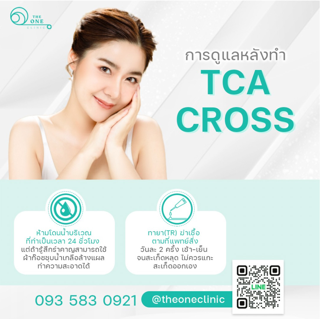 รักษาหลุมสิว TCA Cross | The One Clinic